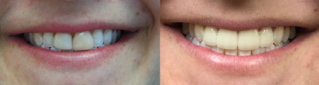 How Veneers Changed My Smile & My Life - Brooks Dental | Winthrop MA | Blog